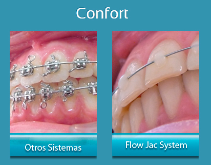 Sobre FlowJac System: Beneficios FlowJac System