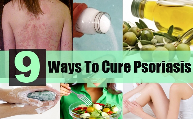 psoriasis skin: Psoriasis 9 Ways to Help You