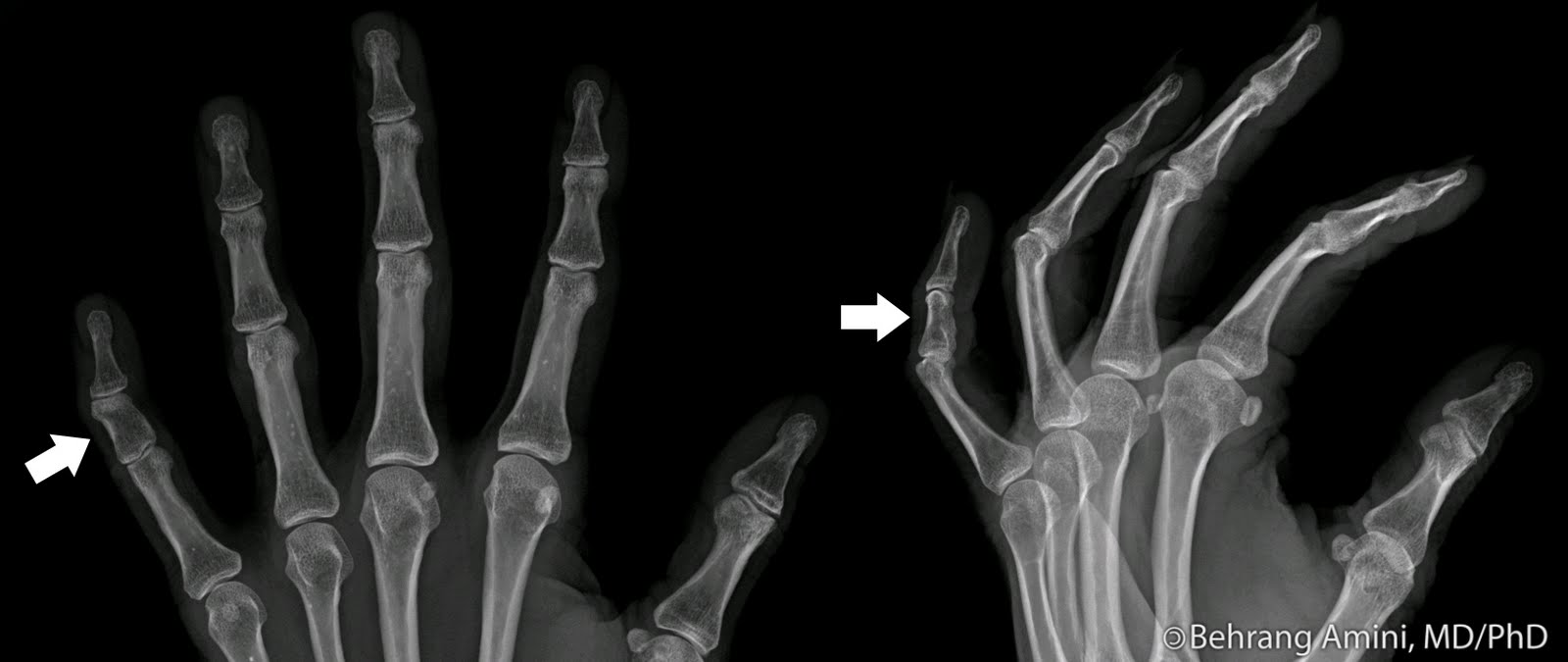 Roentgen Ray Reader: Brachymesophalangia