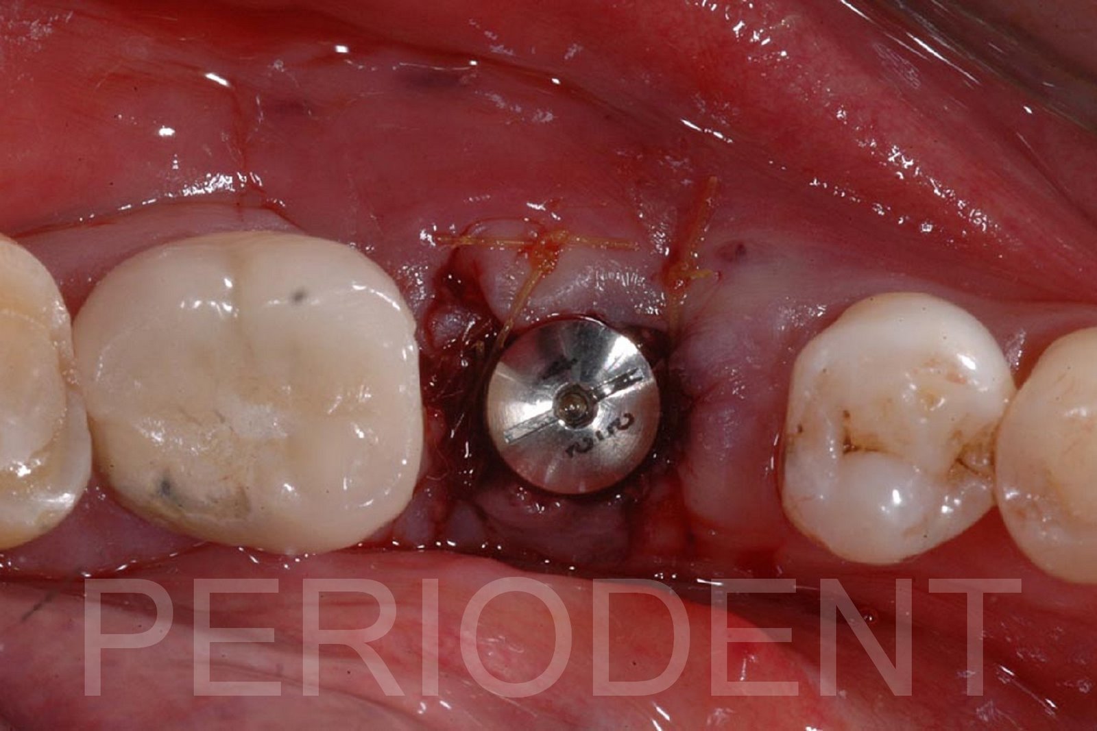 P E R I O D E N T = P E R I O + I M P L A N T: Molar Extraction and ...