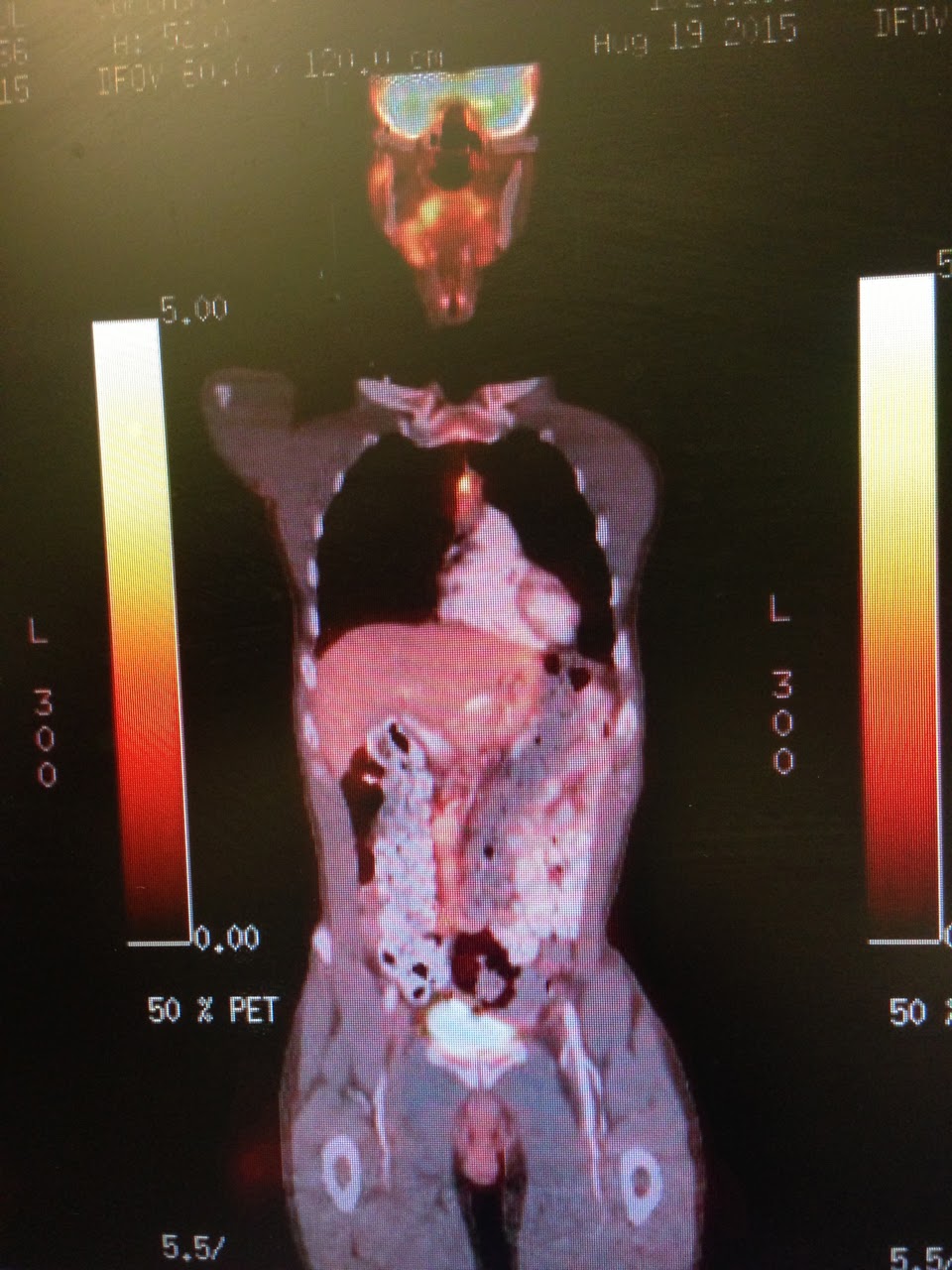 Lyme to Lymphoma: False Positive on PET scan?
