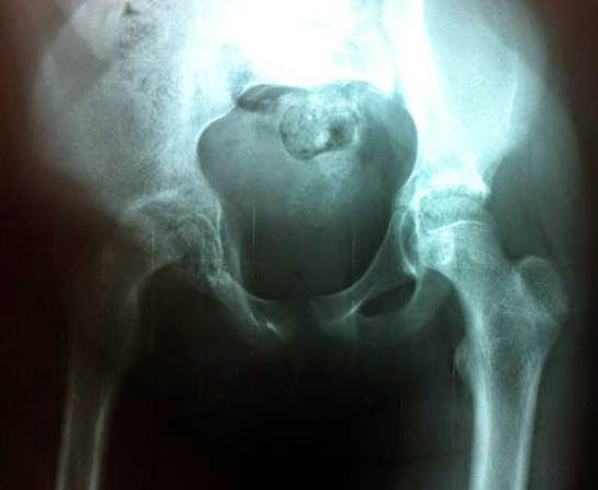 O R T O C R I T I C A: Epifisiolistesis proximal femoral