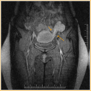 Pelvic congestion syndrome -MRI - Sumer's Radiology Blog