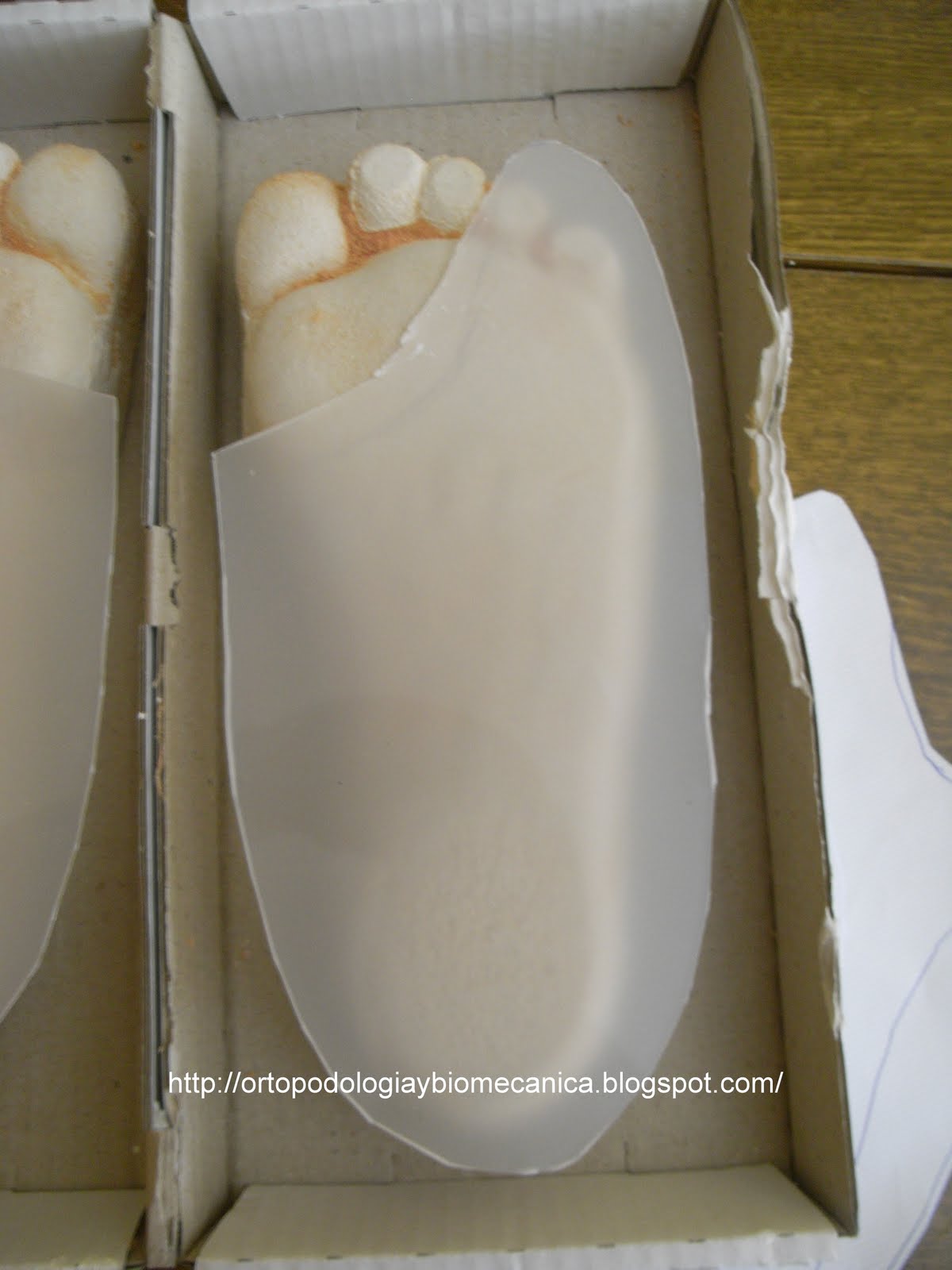 Ortopodologia y Biomecanica : “GAIT PLATE”. TRATAMIENTO METATARSO ADUCTO