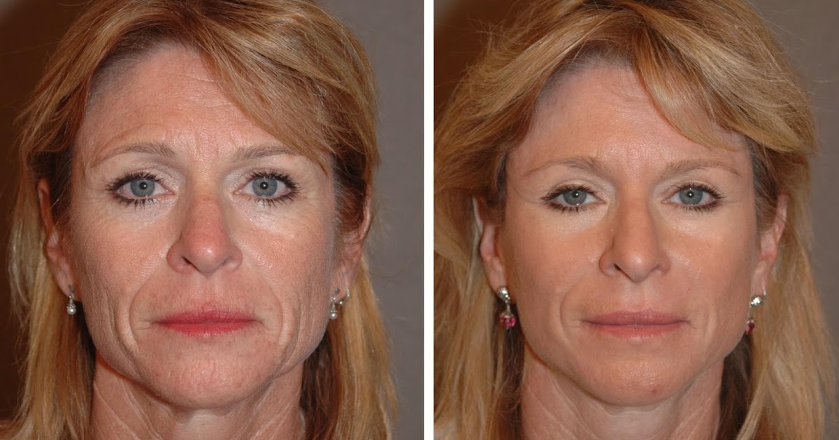 How Long Does it Take to Recover from a Facelift