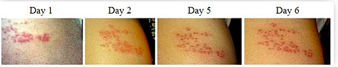 Shingles: Week 5: What should I be looking for?
