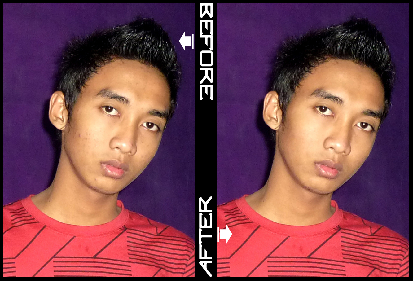 vector screen: Menghilangkan Jerawat Muka, flek hitam, panu, tahi lalat ...