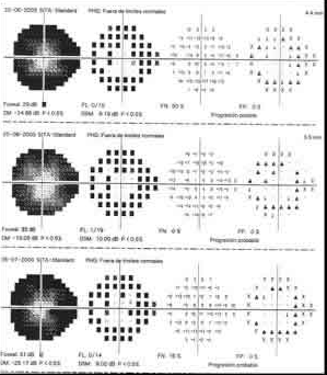 Interpretación Campo visual
