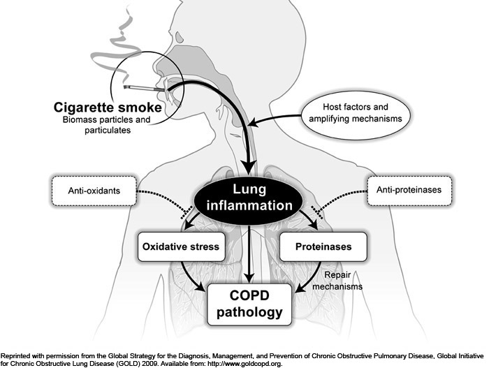 PHARM. D IMPROVING HEALTH: Pathophysiology of COPD
