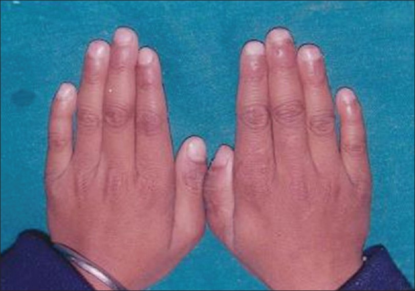 SUHASIS ONLINE: Ectodermal dysplasia with true anodontia