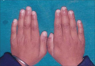 SUHASIS ONLINE: Ectodermal dysplasia with true anodontia