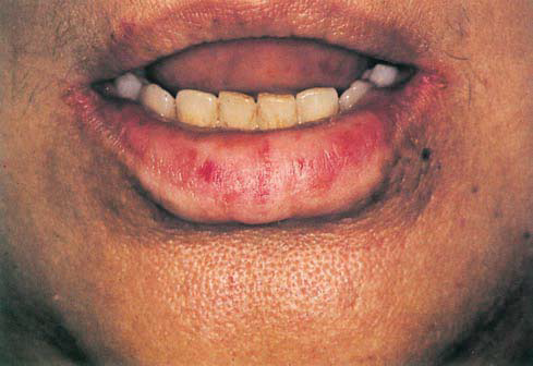 Erythroplakia On Lip