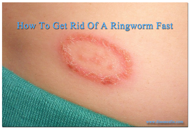 Diseases Fix: How To Get Rid Of Ringworm Fast