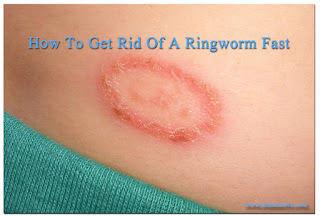Diseases Fix: How To Get Rid Of Ringworm Fast