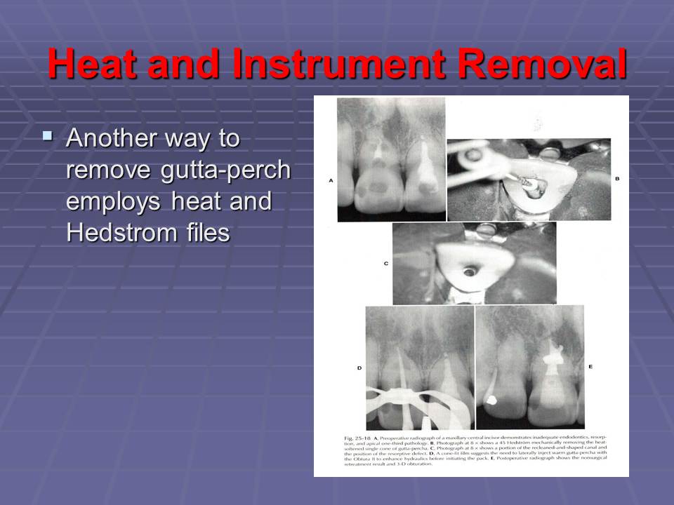 Dentistry: Endodontics, Armamentarium and techniques
