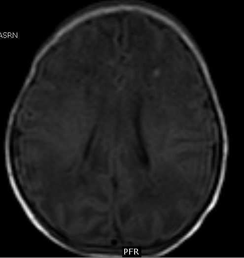 Periventricular leukomalacia -MRI - Sumer's Radiology Blog