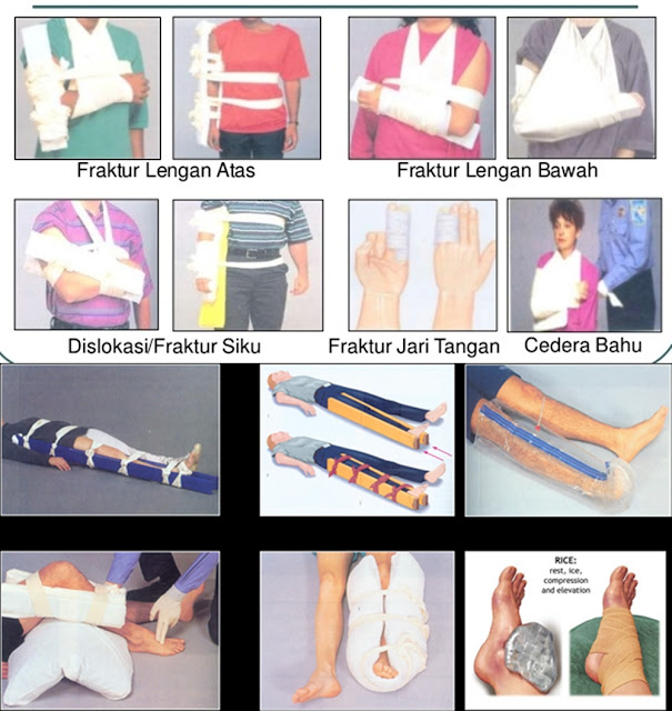 Materi PP: Pembidaian | PMR GAHITA
