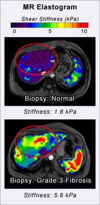 Magnetic Resonance Elastography: Accurately identify the presence and ...