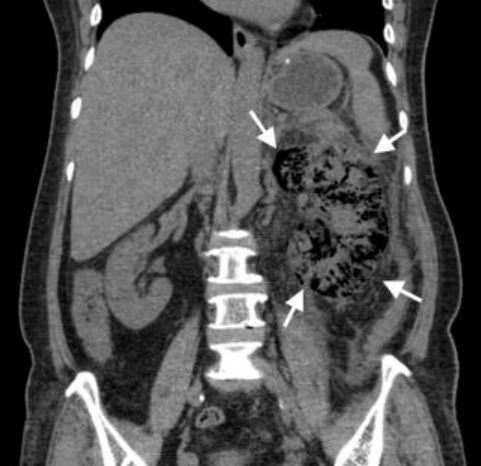 Emphysematous pyelonephritis - Review