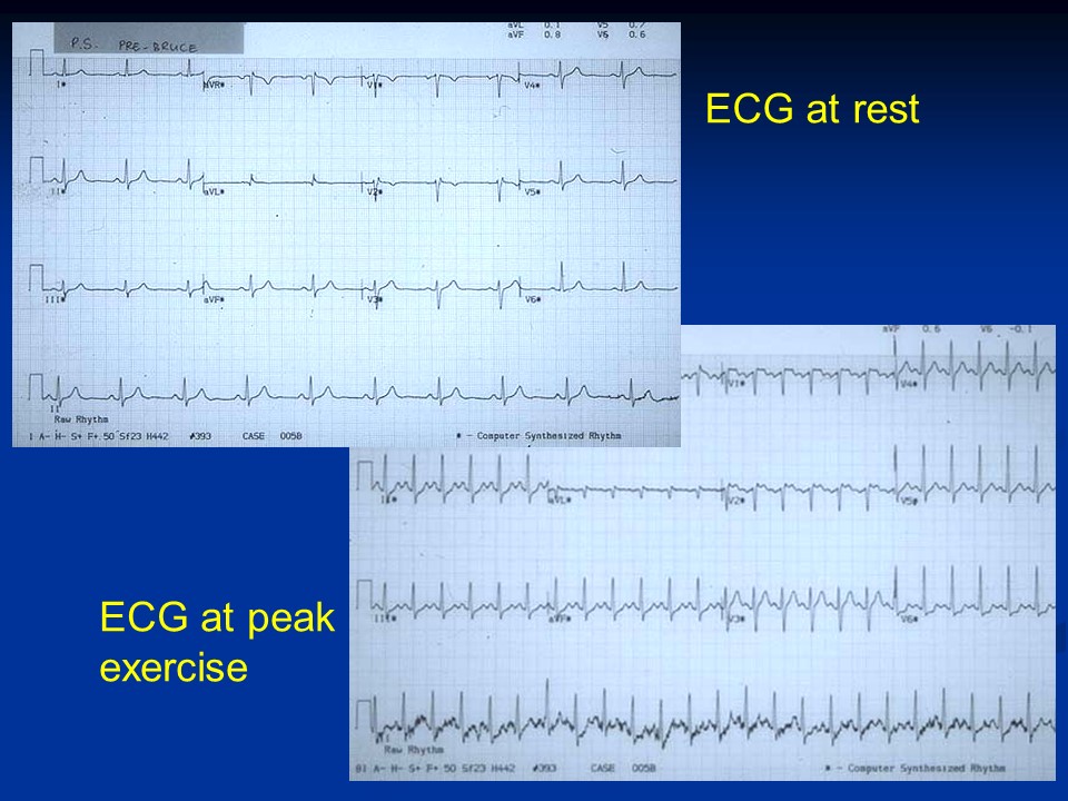 CVT Mohd Farid: Coronary Artery Disease CAD Part I-Credit Dato' Dr ...