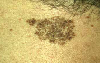 Reseñas en Dermatología: Nevus