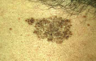 Reseñas en Dermatología: Nevus