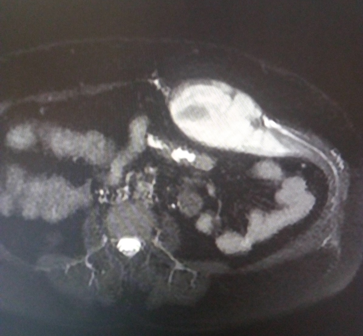 Abdominal wall mass –MRI Approach - Sumer's Radiology Blog