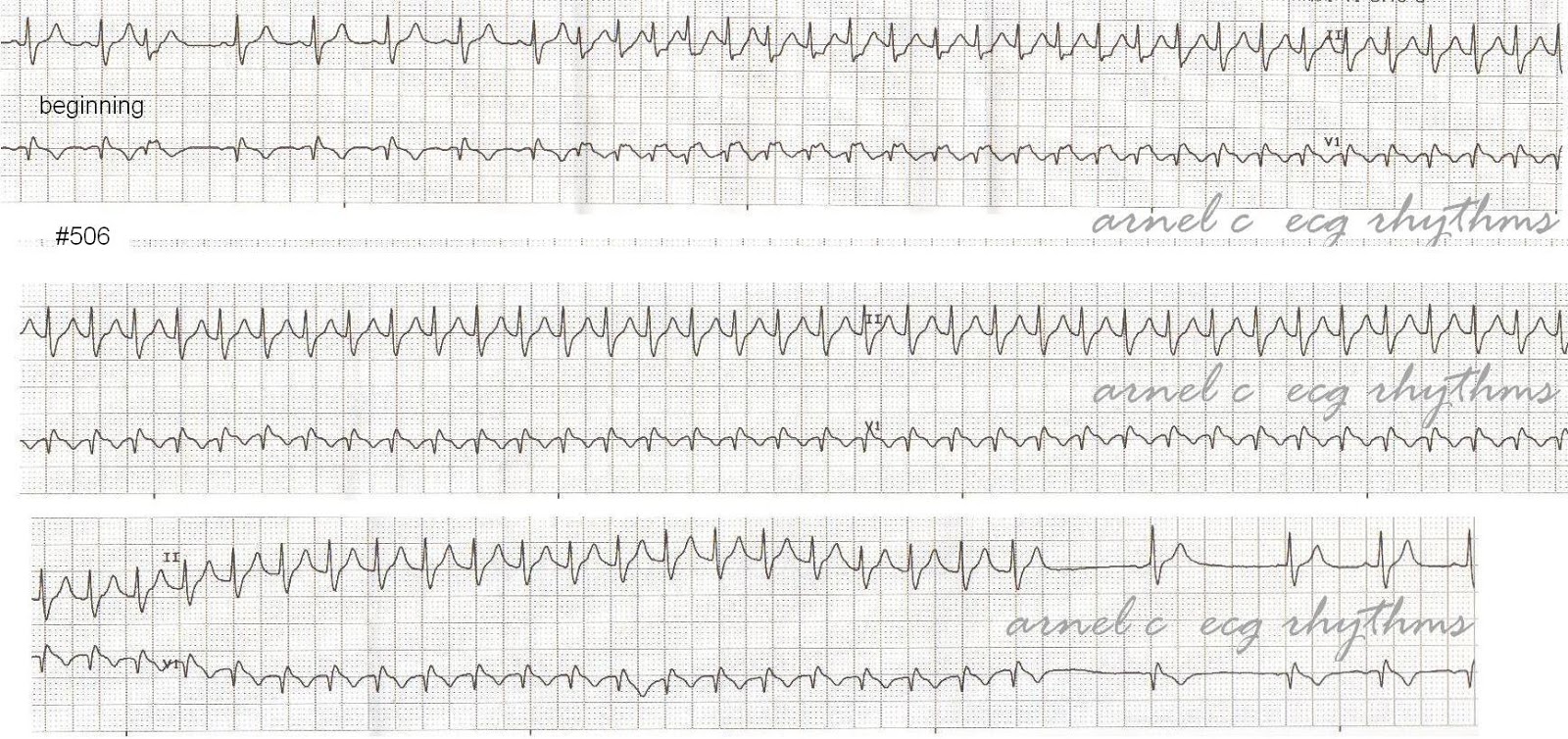 ECG Rhythms: Which SVT? The need to capture the beginning of an SVT