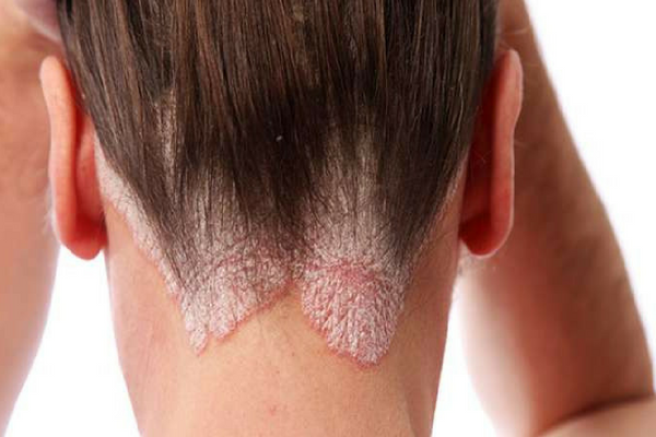 Mengenal Masalah Kulit Kepala 'Psoriasis' dan ini Cara Mengobatinya