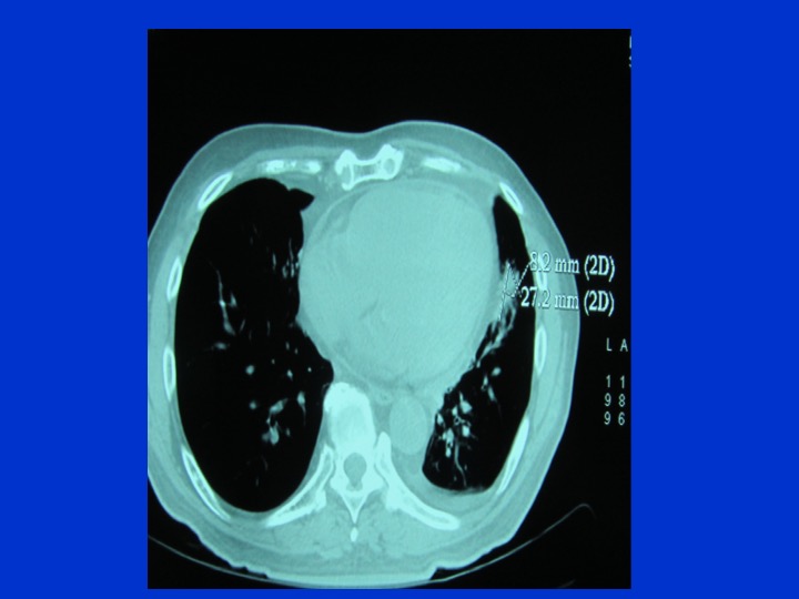 Kuching Urology古晉秘尿專科: Lower urinary tract symptoms LUTS and prostate ...