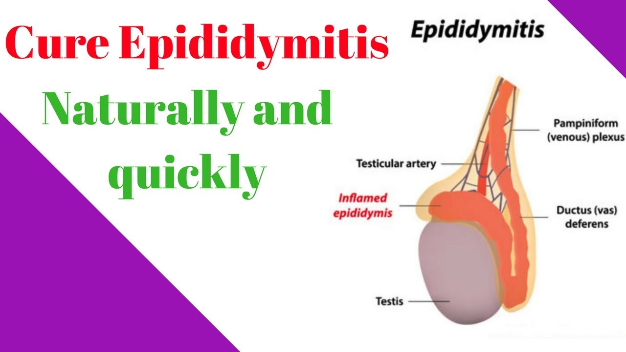 Epididymitis Lump