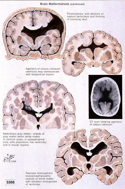 neuropathology blog: Brain Malformations