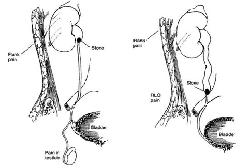 .: Medicina Islamica :.: Batu Saluran Kemih