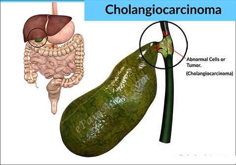 Cholangiocarcinoma