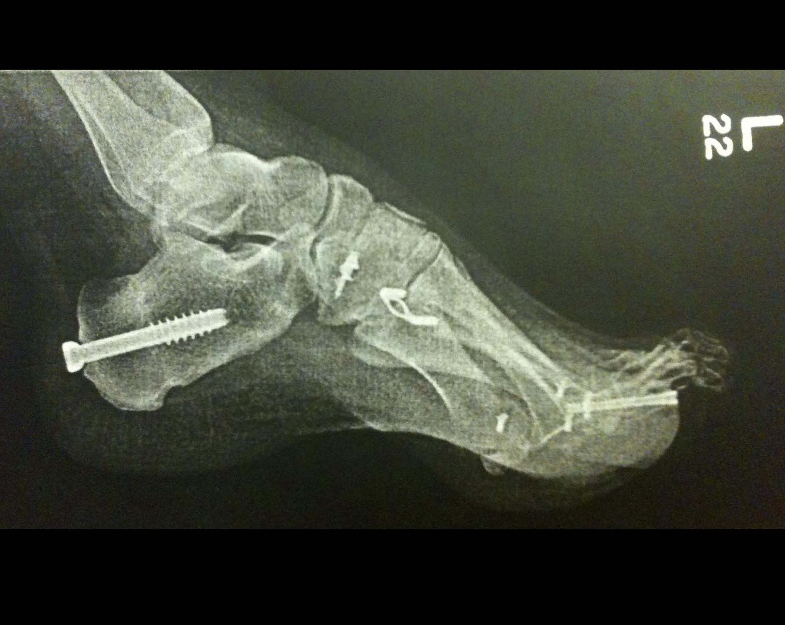 Foot Surgery for CMT