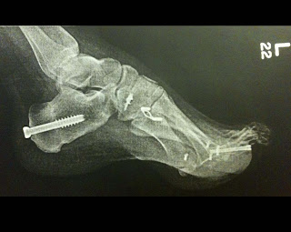 Foot Surgery for CMT: 4 Months P.O. - An Update and An Apology...