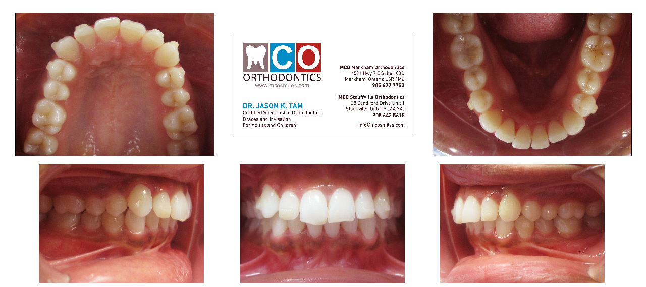 Toronto Invisalign - Brand New Smile :): 16 Month Progress Photos With ...