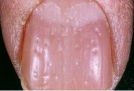 Nail pitting: Nail pitting causes