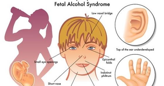 gebeurtenissen: FAS, Foetaal Alcohol Syndroom