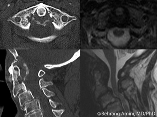 Roentgen Ray Reader: Calcium Pyrophosphate Dihydrate Deposition around ...