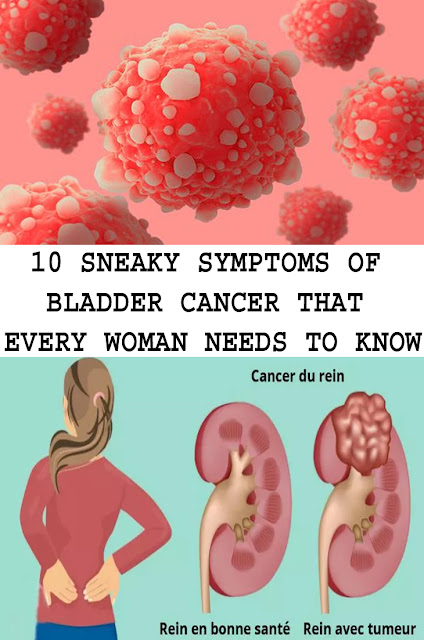 10 SNEAKY SYMPTOMS OF BLADDER CANCER THAT EVERY WOMAN NEEDS TO KNOW
