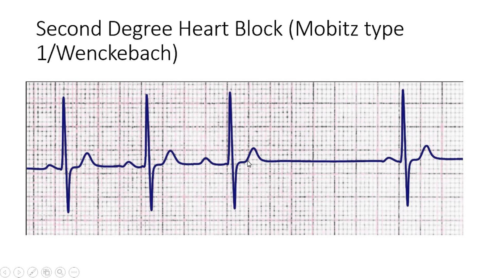 Prepare For Medical Exams Wenckebach Or Type I Second degree AV Block prepare-for-medical-exams-wenckebach-or-type-i-second-degree-av-block