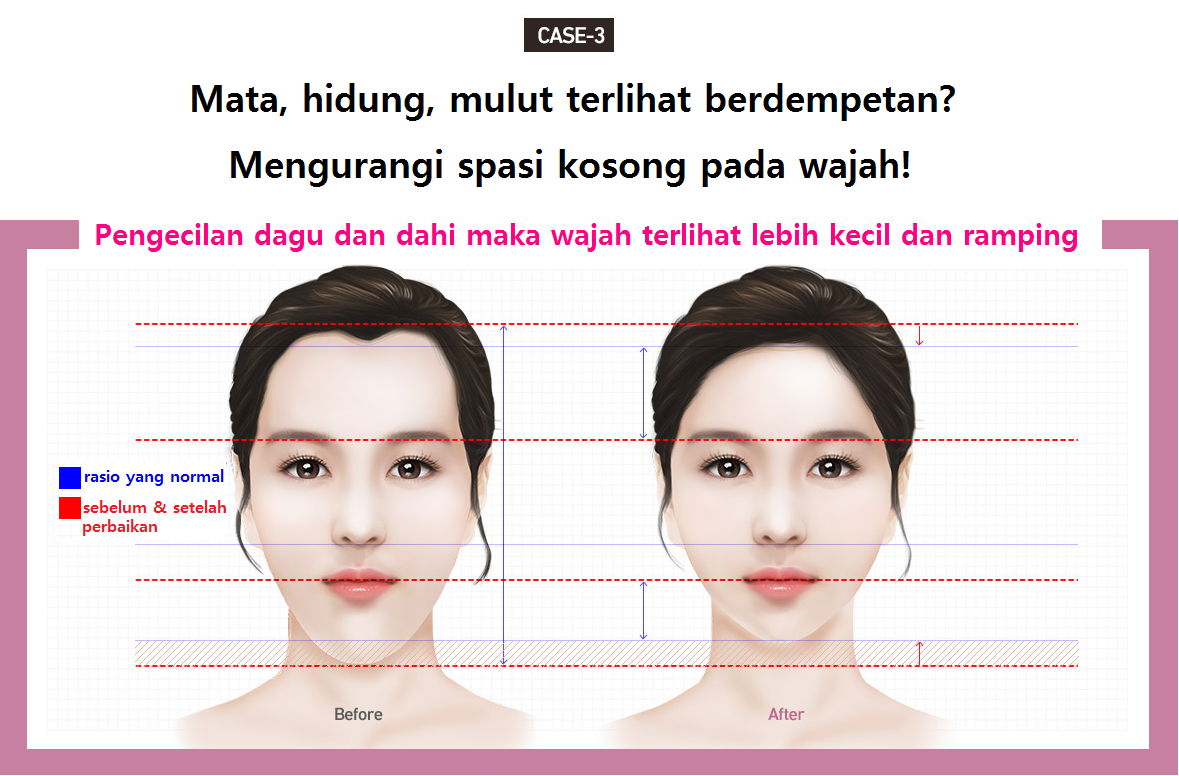 Operasi Plastik di Korea, ID Hospital: Wajah yang kecil, wajah yang ...