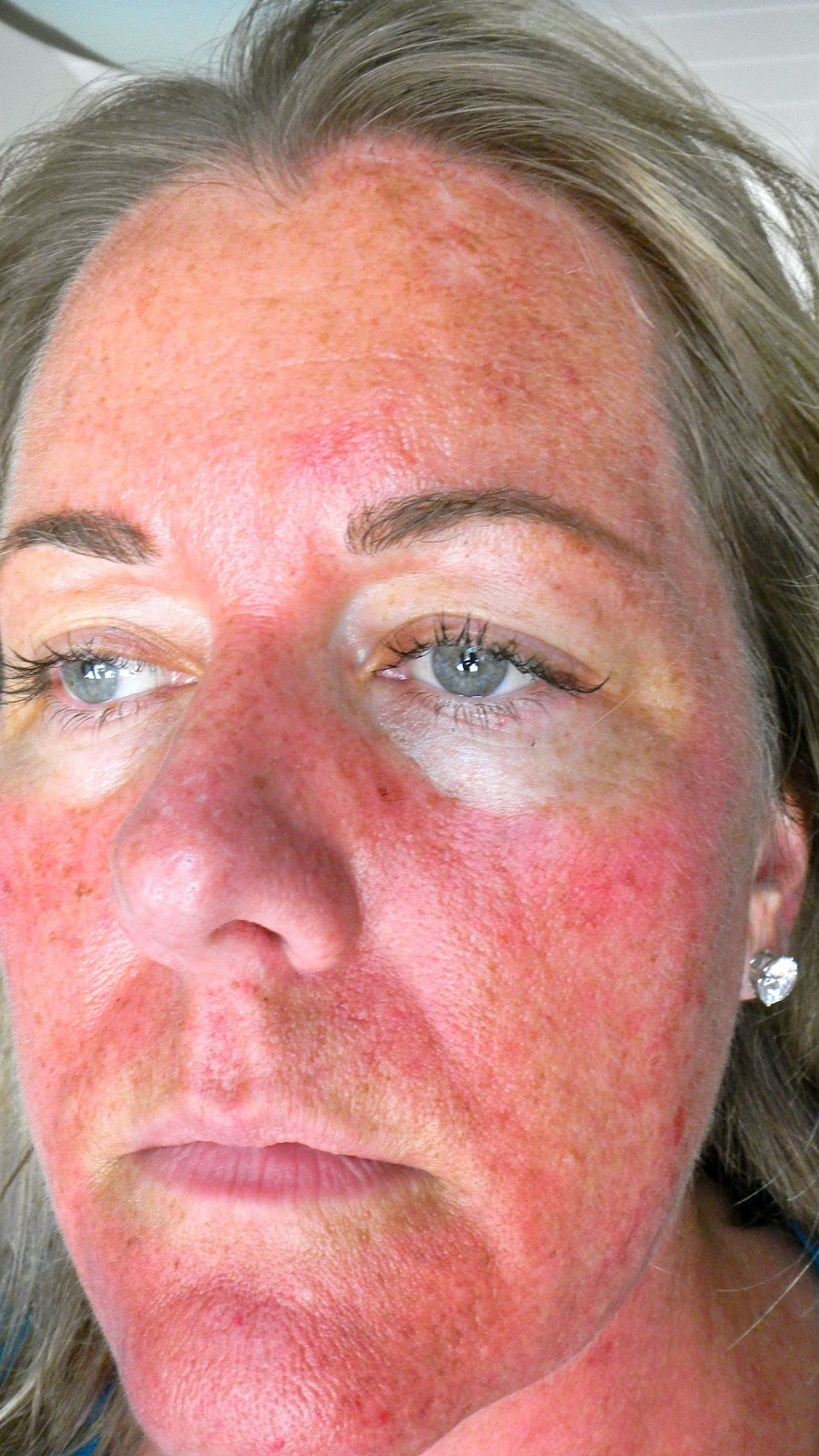 Efudex and Me 2013: 05/23/13