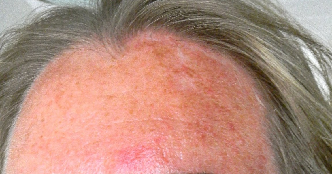 Efudex and Me 2013: Efudex Day Ten