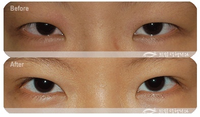Teuim Aesthetic Plastic Surgical Clinic Dr.Kwon: Difference of eyes ...