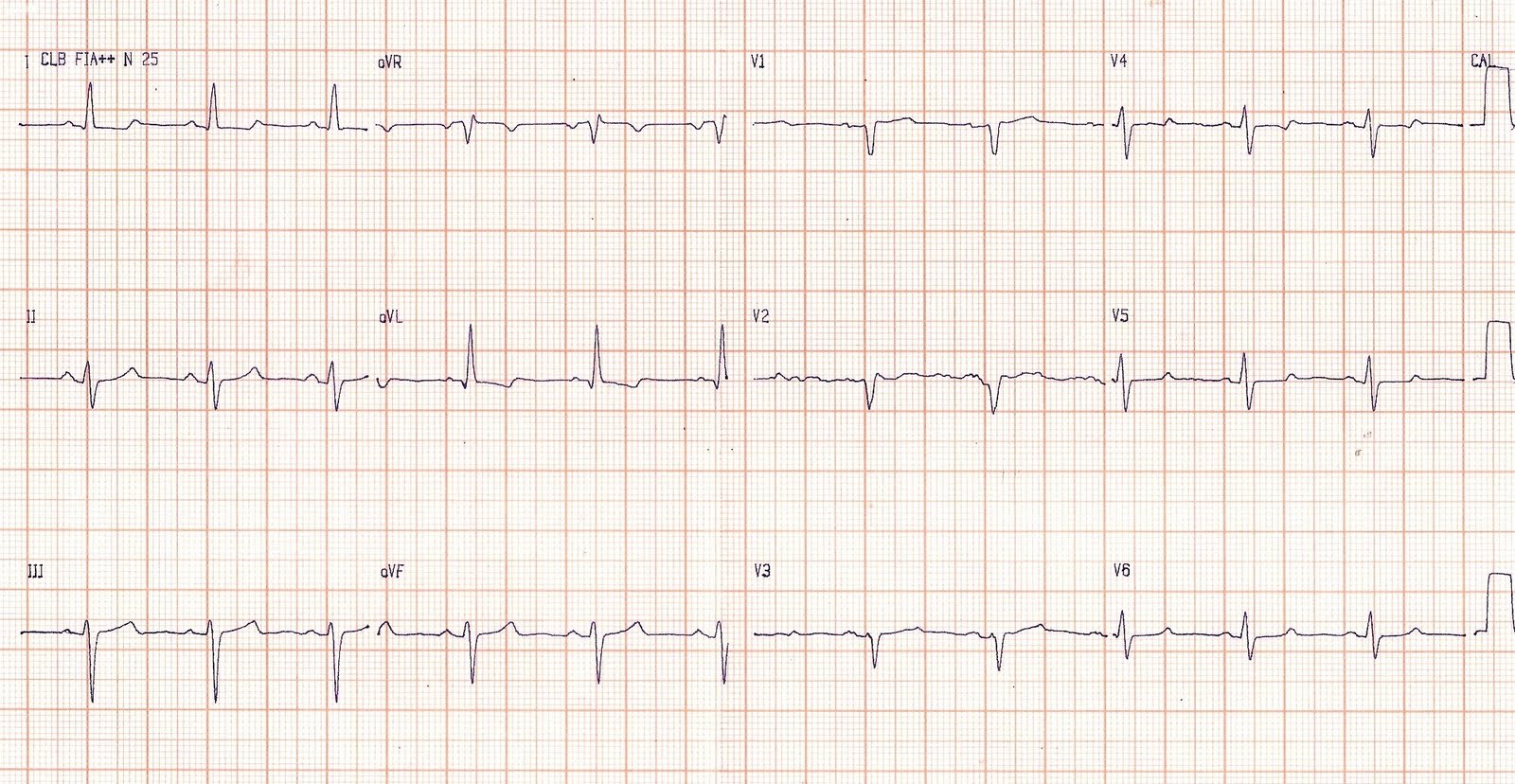 Blog de Eletrocardiografia: POBRE PROGRESSÃO DE R E ONDAS Q NAS ...