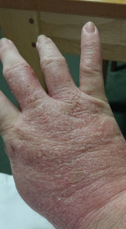 Obat Eksim Menggunakan Kunyit Yang Bisa Langsung Anda Coba - Simzem