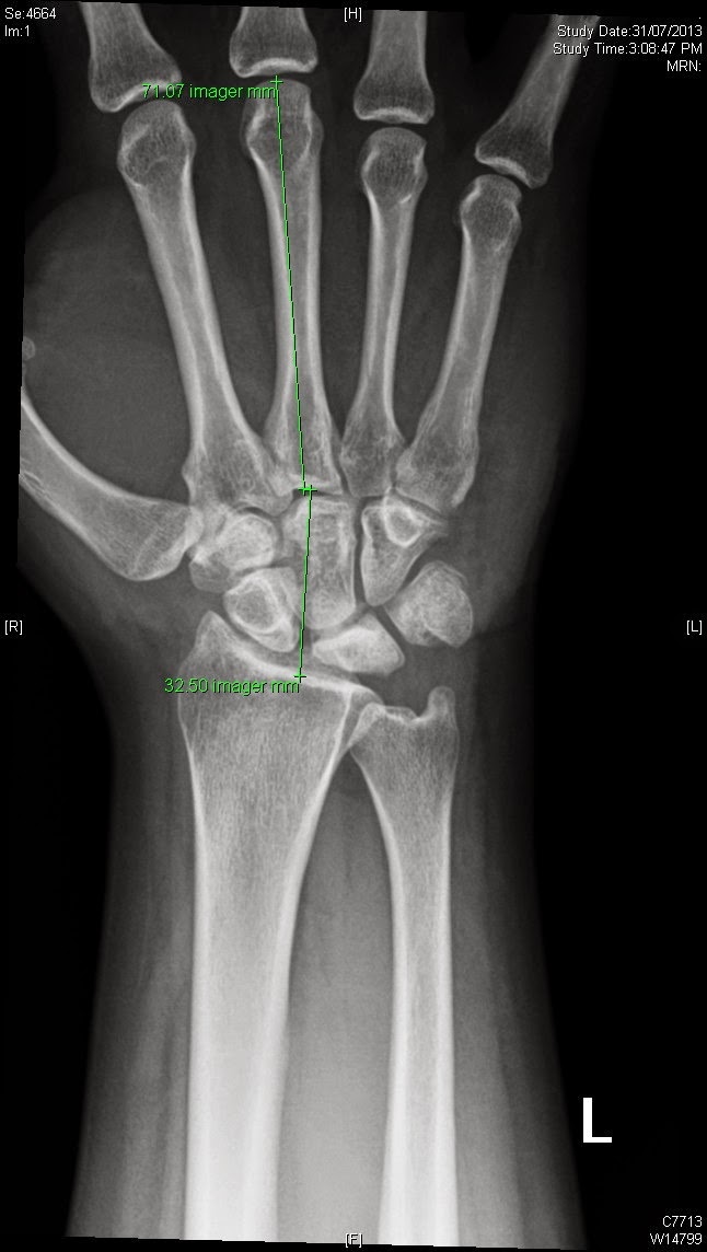 Joint Preservation and Replacement : Painful left wrist in a rt handed ...