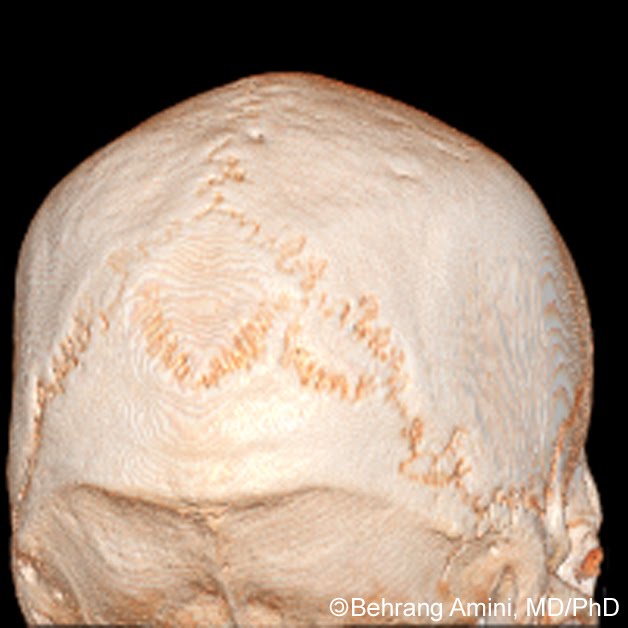 Roentgen Ray Reader: Wormian Bones